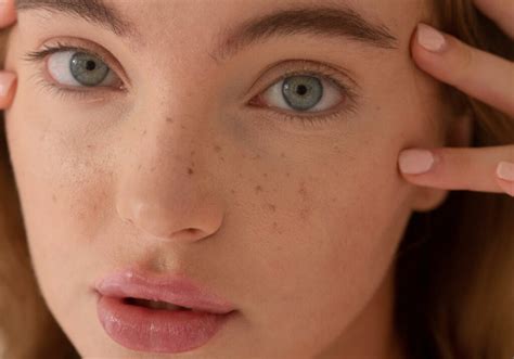 Botox After Care Guide – Worauf Sie nach einer Botulinumtoxin ...