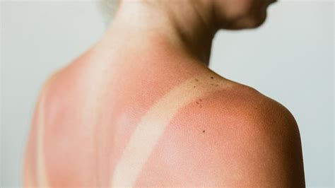 We know that the sun causes deadly skin cancer, so why are we still ...