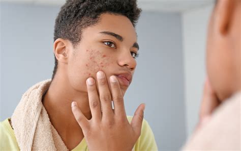 İzotretinoin Nedir? - Probiyotix