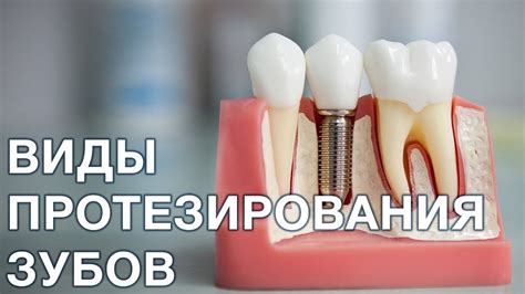 Протезирование зубов. Виды протезирования зубов. Микро протезирование ...