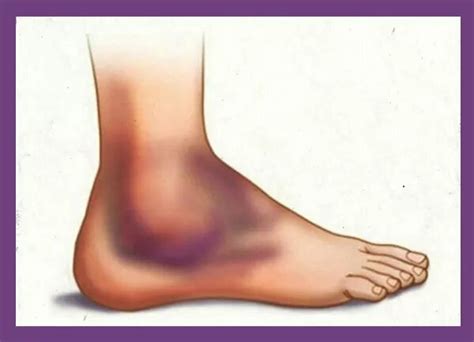 Розтягнення зв'язок гомілковостопного суглоба | Медичний Центр MEDICAL ...