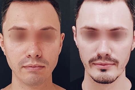 Ментопластика — пластика подбородка, цены в VIP Clinic в Москве