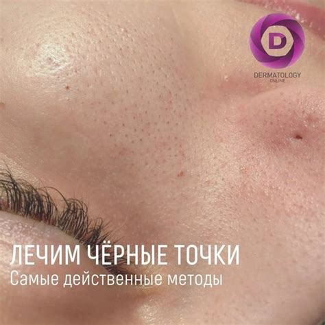 Чёрные точки на лице, лечение, лучшие методы