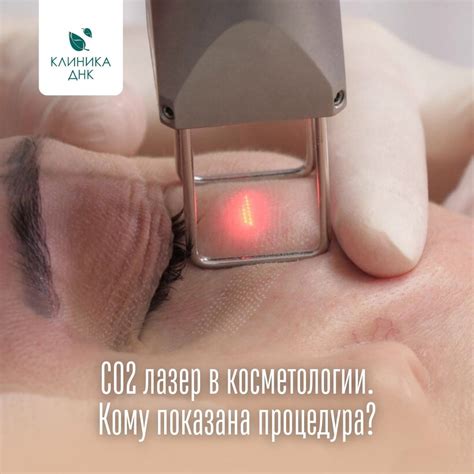 CO2 лазер в косметологии | Новости медицинского центра Клиника ДНК
