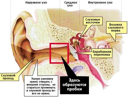 Корнет всегда: медицина пробки в ушах