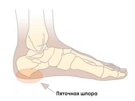 Пяточная шпора – методы лечения, диагностика, симптомы, препараты ...