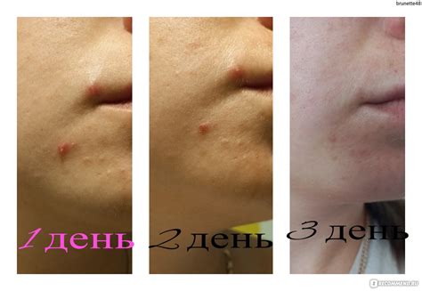Сыворотка для лица LEFAMI Acne Remover Serum для удаления акне ...