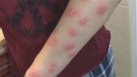 Woman Sues Atlantis Paradise Island Resort Over Bed Bug Bites – NBC 6 ...