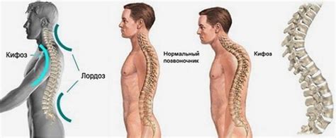Кифоз - признаки, причины, симптомы, лечение и профилактика - iDoctor.kz