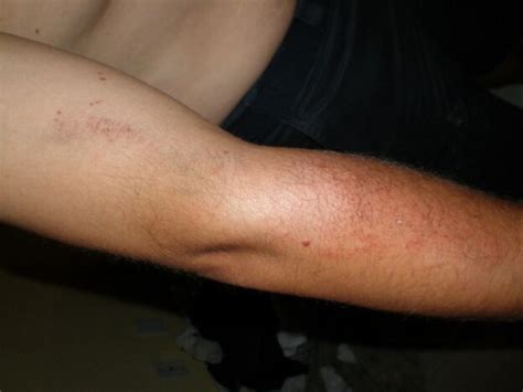 Road Rash is a Serious Bicycle Accident Injury - Ladah Law Firm