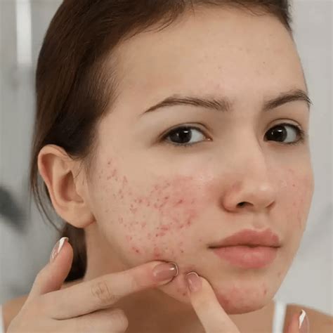 Wellness Treatments for Acne | °CRYO Stay Young