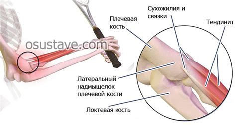 Тендинит локтевого сустава (воспаление сухожилий): симптомы и лечение ...