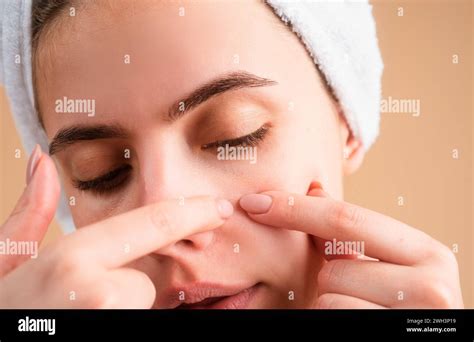 Girl squeezing pimples on face. Acne blemish spots skin on young woman. Spot scar acne, freckles ...
