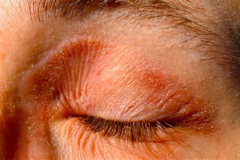 Eyelid Eczema (Eyelid Dermatitis): Symptoms, Causes, and Treatment ...