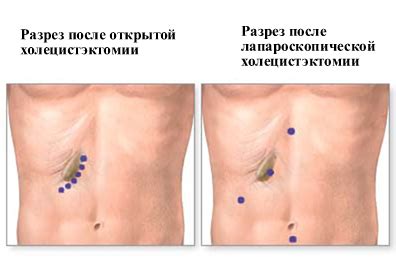 Полостная операция по удалению желчного пузыря