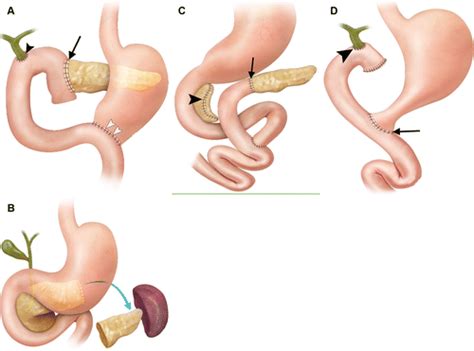 Imaging after Pancreatic Surgery: Expected Findings and Postoperative Complications | RadioGraphics