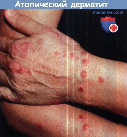 Кожа при атопическом дерматите (АД)