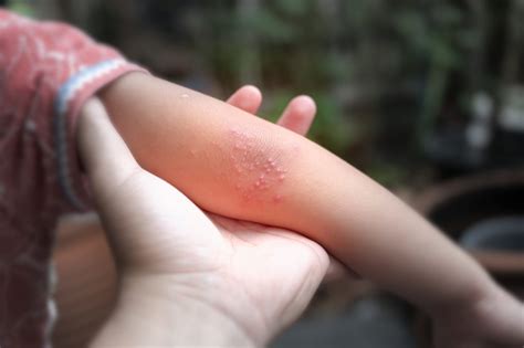 Here's what you need to know about Monkeypox - NICD