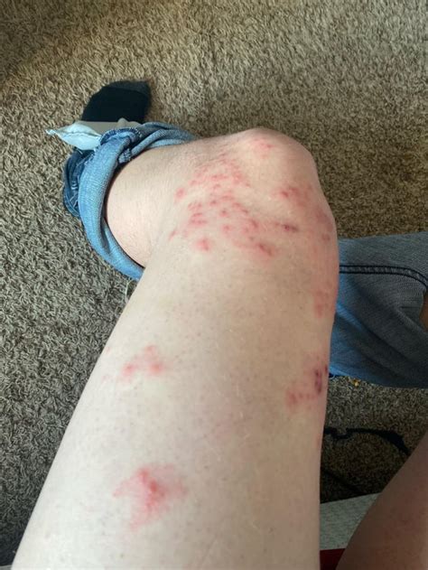 Really Strange Rash accompanied with hip/groin pain : r/DermatologyQuestions