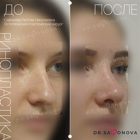Ринопластика в Санкт-Петербурге - цены на пластику носа в Институте ...
