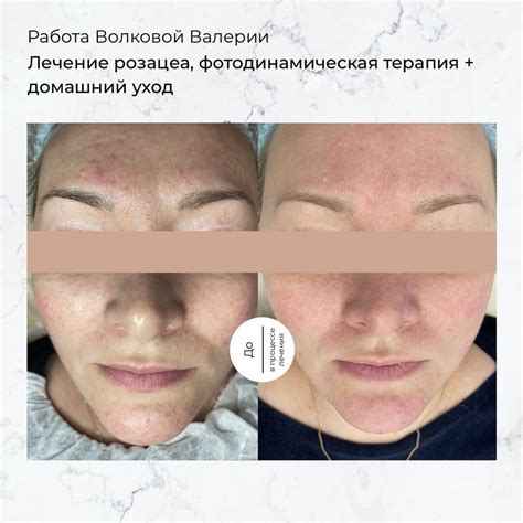 Фотодинамическая терапия - Услуги