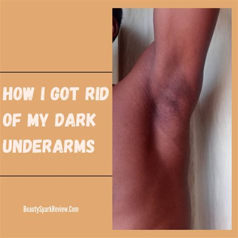 How i got rid of my dark underarms in 4 weeks the comprehensive guide – Artofit