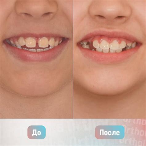 Детская ортодонтия с открытым прикусом: кейс врача-ортодонта Марии ...