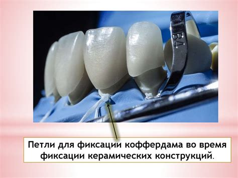 Изоляция рабочего поля. Рамки для коффердама - презентация онлайн
