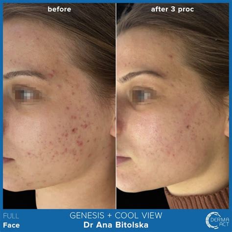 Гъбички по ноктите - локализиране и лечение | Derma-Act