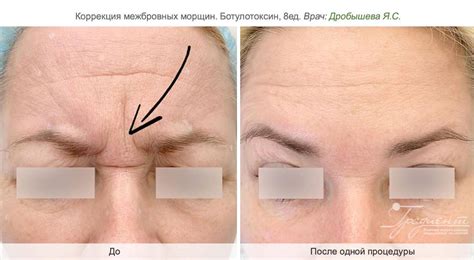 Тейпирование межбровной морщины. Видео, схема, фото до и после, отзывы