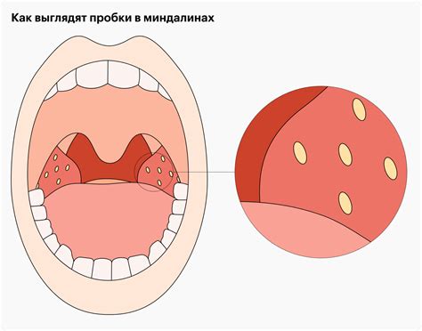 Пробки в миндалинах: что это, как убрать, почему образуются, нужны ли ...