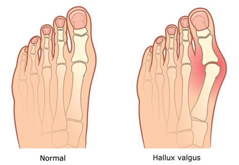Hallux Valgus (Bunion) - Médicus