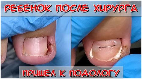 Ребенок после хирурга пришел к подологу / Вросший ноготь на ноге ...