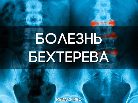 Болезнь Бехтерева