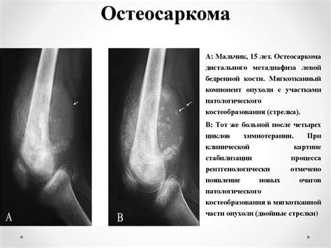 Остеосаркома. Эпидемиология остеосаркомы - презентация онлайн