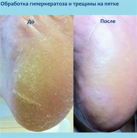 Гиперкератоз стоп - леченеи и обработка в СПб, цена, врачи