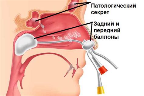 Гайморит: симптомы; хронический; как лечить дома; прокол пазухи