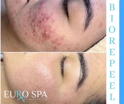 Want Amazing Skin? – You need BioRepeel for Face & Body - Naples ...