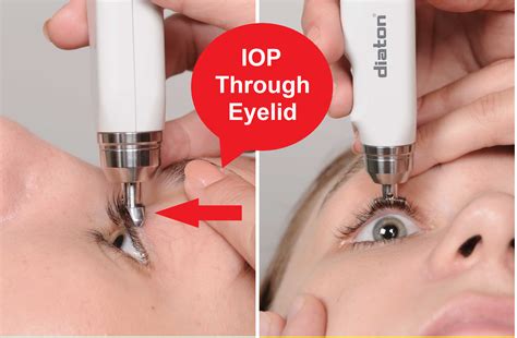 diaton-tonometer-2-IOP-through-Eyelid_3164x2000 – Tonometer Diaton