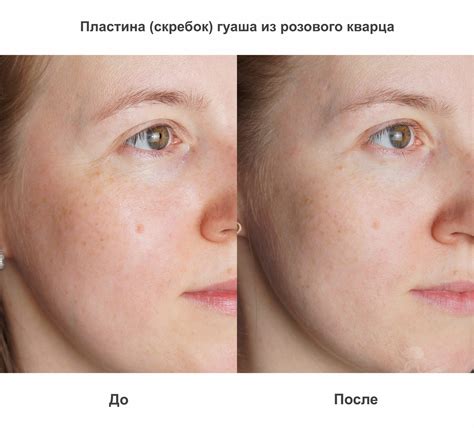 Гуаша Отзывы До И После Фото — Картинки фотографии
