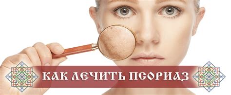 Народные средства от псориаза: травы, мазь и т.д.