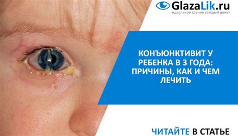 Конъюнктивит у ребенка в 3 года: причины, как и чем лечить