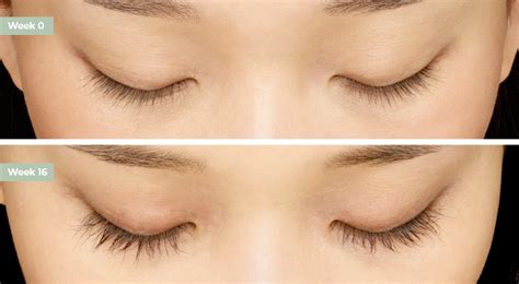 Latisse | Latisse 5ML - 10-Week Supply