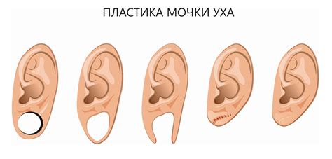 Восстановление ушей после тоннелей: зарастают ли, как убрать тоннели ...