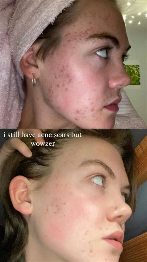 Niacinamide 10% + Zinc 1% – MIRUSKINCARE