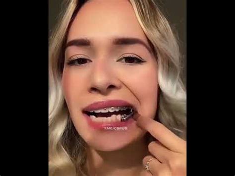Аппарат Гербста в действии - YouTube