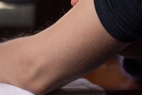 Keratosis Pilaris: How to Treat This Skin Condition | Banner