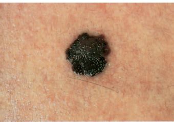 Melanoma - BobakMarlene
