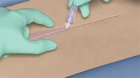 DERMABOND ADVANCED® Topical Skin Glues & Adhesives | J&J MedTech