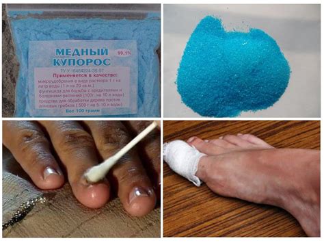 Как избавиться от грибка на ногтях ног быстро народными средствами ...